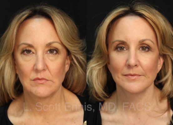Mar-a-Lago Facelift a Refined & Timeless Look with Dr. Scott Ennis