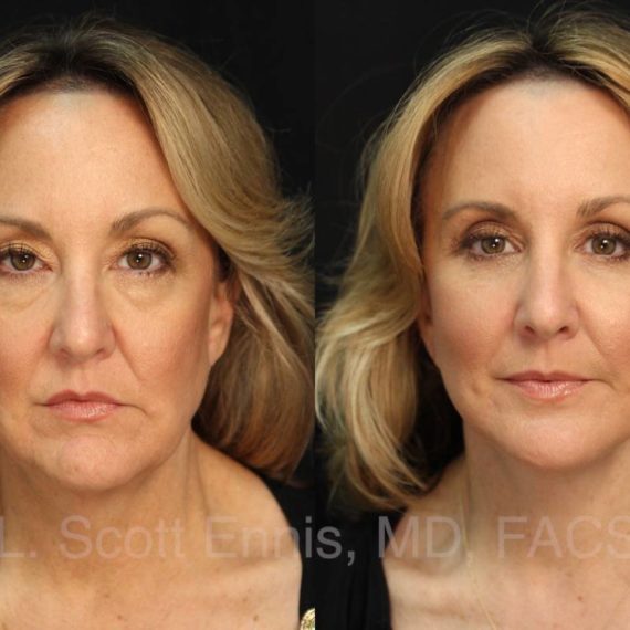 Mar-a-Lago Facelift a Refined & Timeless Look with Dr. Scott Ennis