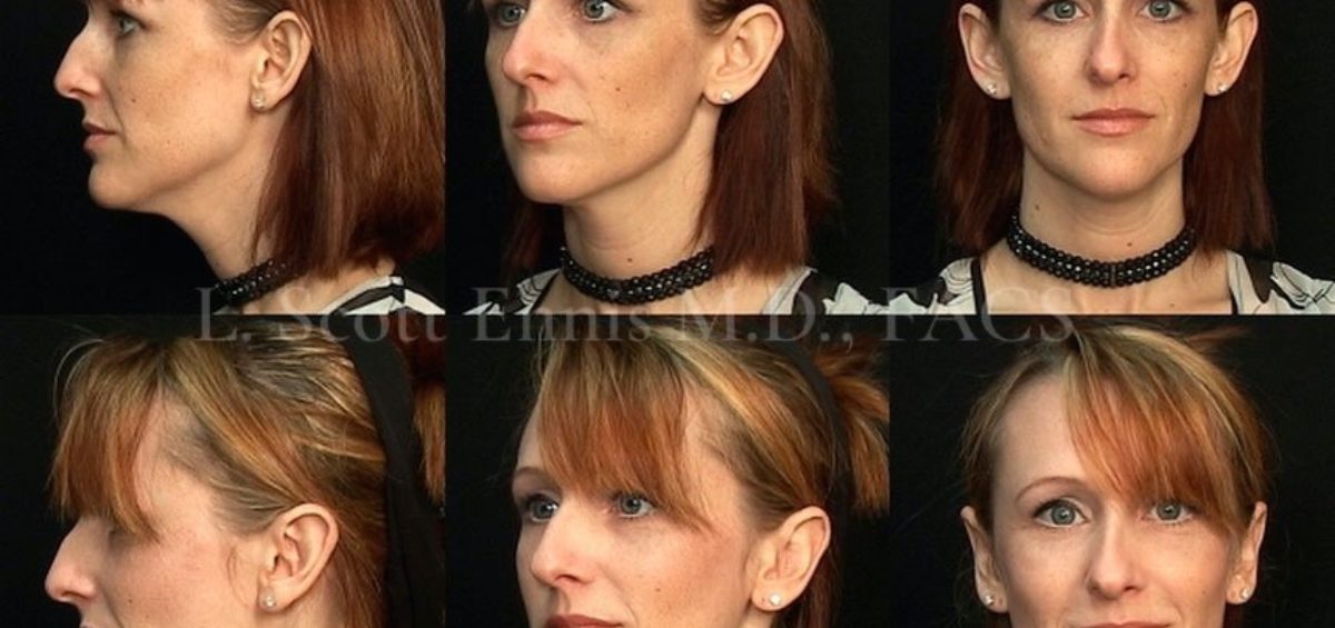 Otoplasty Ear Surgery in Palm Beach at Ennis Plastic Surgery | Boca Raton