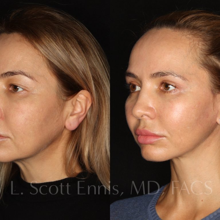 Buccal Fat Pad Treatment Process with Dr. Ennis in Boca Raton