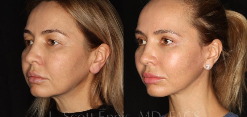 Buccal Fat Pad Treatment Process with Dr. Ennis in Boca Raton