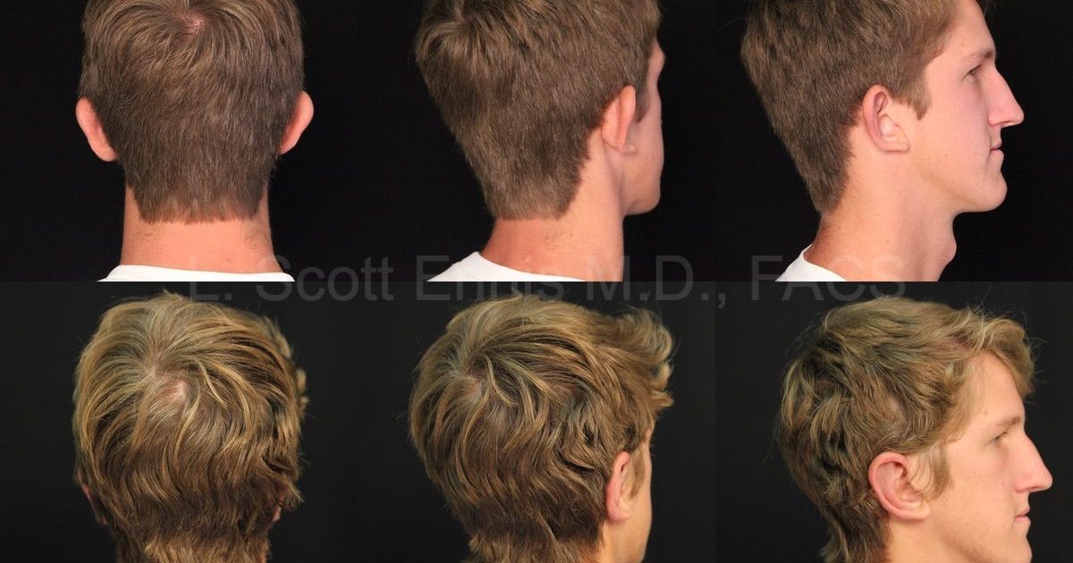 Otoplasty Ear Surgery in Palm Beach at Ennis Plastic Surgery | Boca Raton