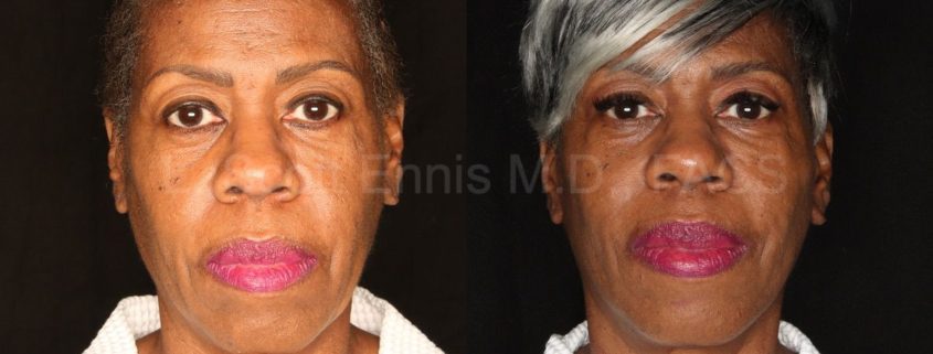 Deep Plane Facelift Surgery in Boca Raton with Dr. Ennis (Vertical)