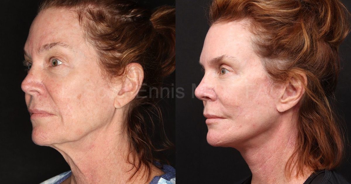 Difference Between Deep Plane and SMAS Facelifts