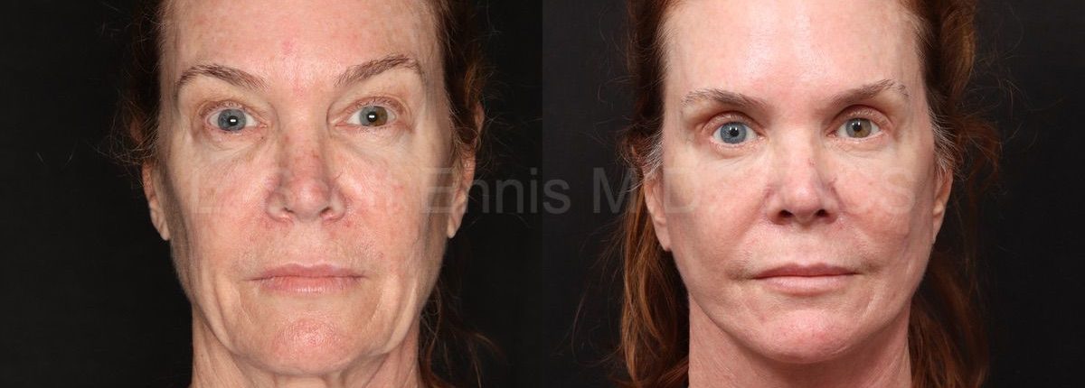 Facial Plastic Surgery & Non-Surgical Face Treatments in Boca Raton ...