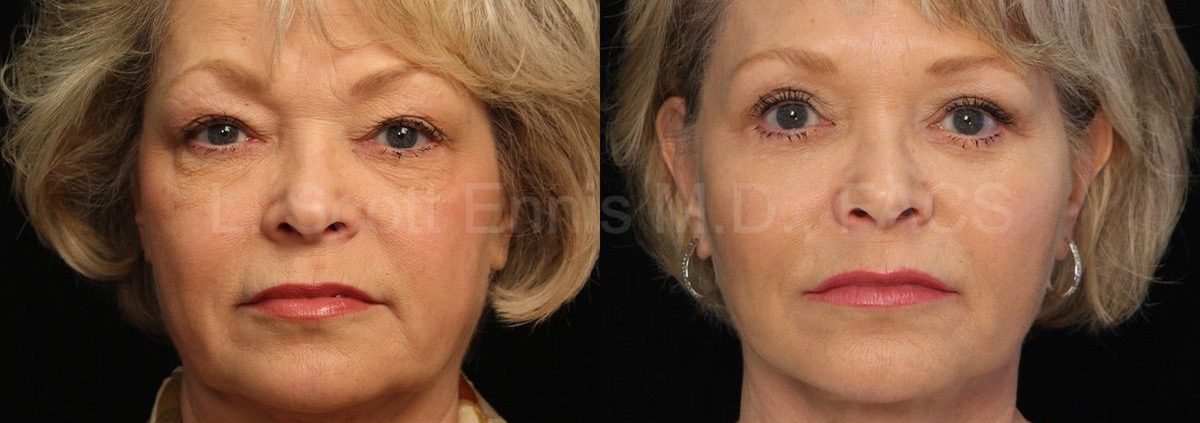 Deep Plane Facelift Surgery in Boca Raton with Dr. Ennis (Vertical)