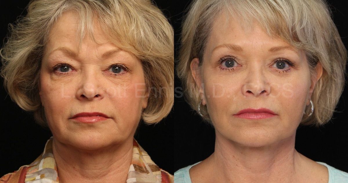 Deep Plane Facelift Surgery in Boca Raton with Dr. Ennis (Vertical)