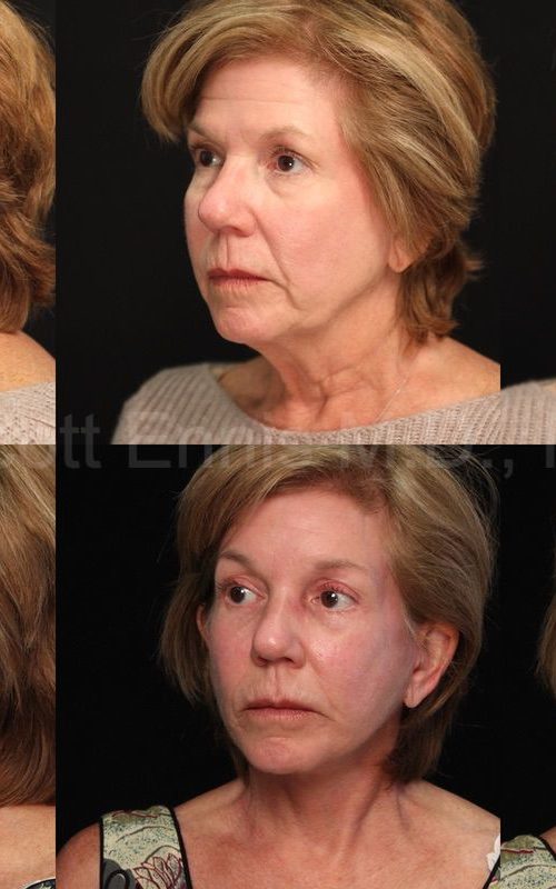 Brow Lift vs Upper Blepharoplasty with Dr. Ennis