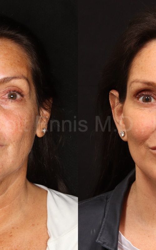 The Mar-a-Lago Face is a Refined & Timeless Look by Dr. Ennis