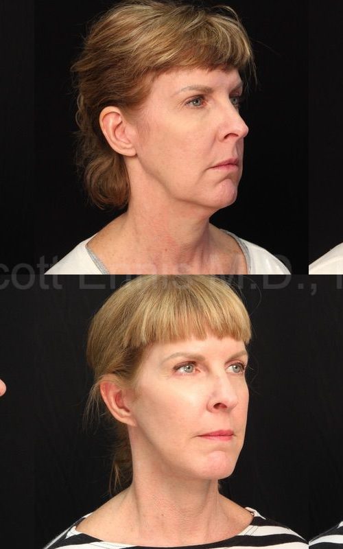 Buccal Fat Removal in Boca Raton, FL with Dr. L. Scott Ennis