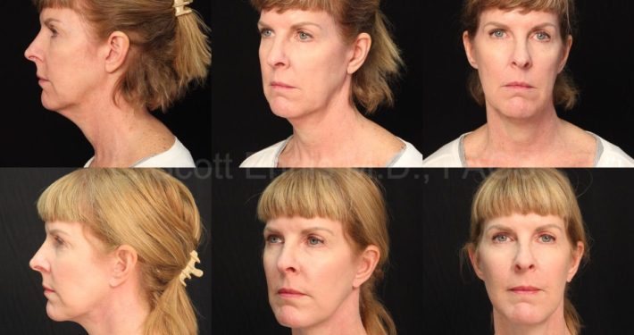Buccal Fat Removal in Boca Raton, FL with Dr. L. Scott Ennis
