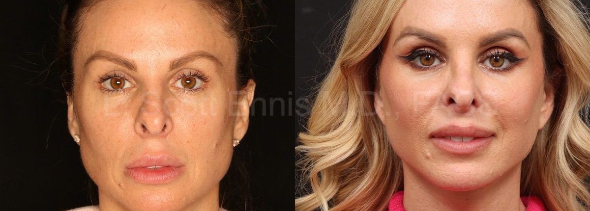 Mar-a-Lago Facelift a Refined & Timeless Look with Dr. Scott Ennis