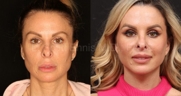 Mar-a-Lago Facelift a Refined & Timeless Look with Dr. Scott Ennis