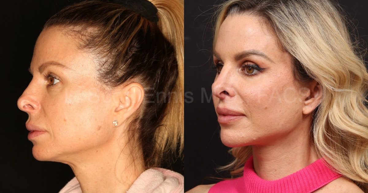 Eyelid Surgery (Blepharoplasty) Boca Raton | Ennis Plastic Surgery