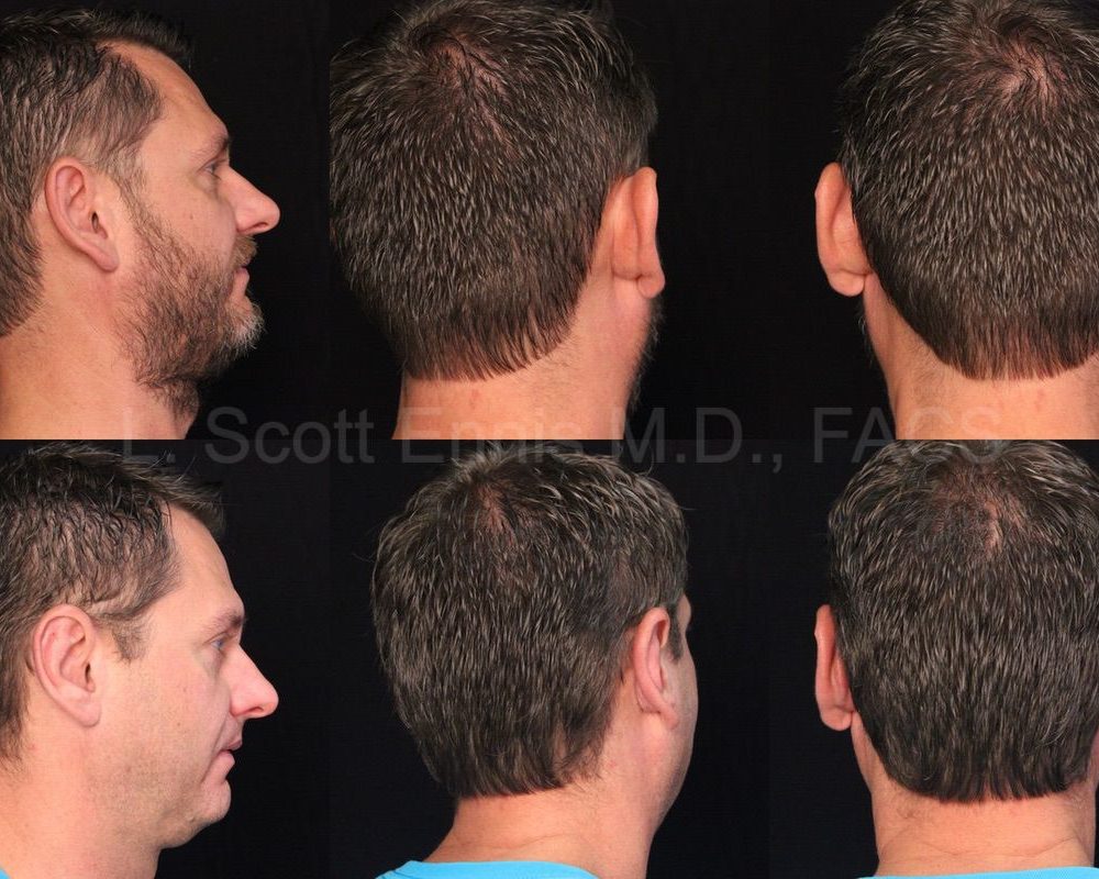 Otoplasty Ear Surgery in Palm Beach at Ennis Plastic Surgery | Boca Raton