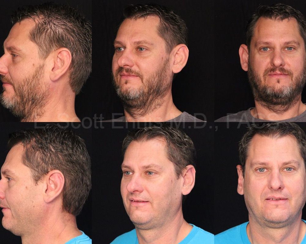 Otoplasty Ear Surgery in Palm Beach at Ennis Plastic Surgery | Boca Raton