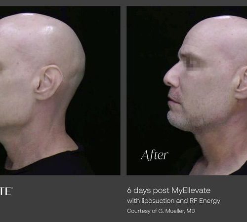 Neck Lift with Suture Suspension & No Scars by Dr. Ennis in Boca Raton