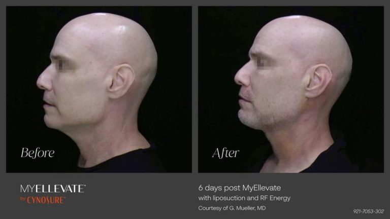 Neck Lift with Suture Suspension & No Scars by Dr. Ennis in Boca Raton