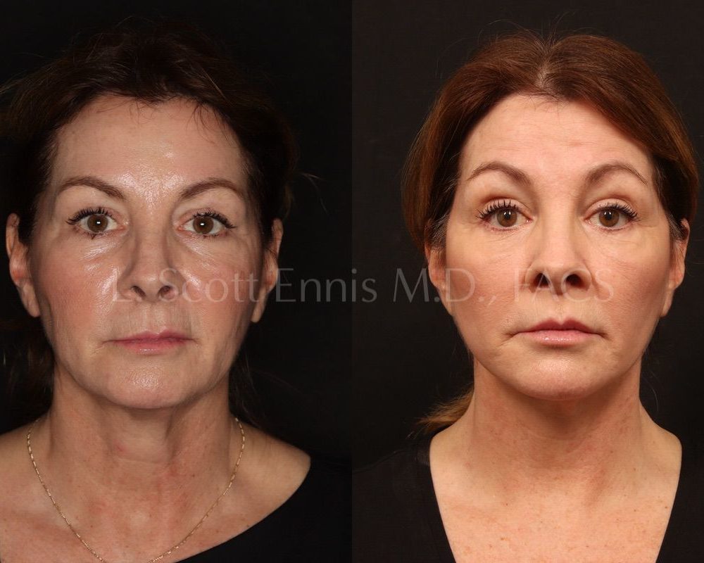 Lip Lift: Corner, Bullhorn, & Upper Lip Lift Treatment | Dr. Ennis