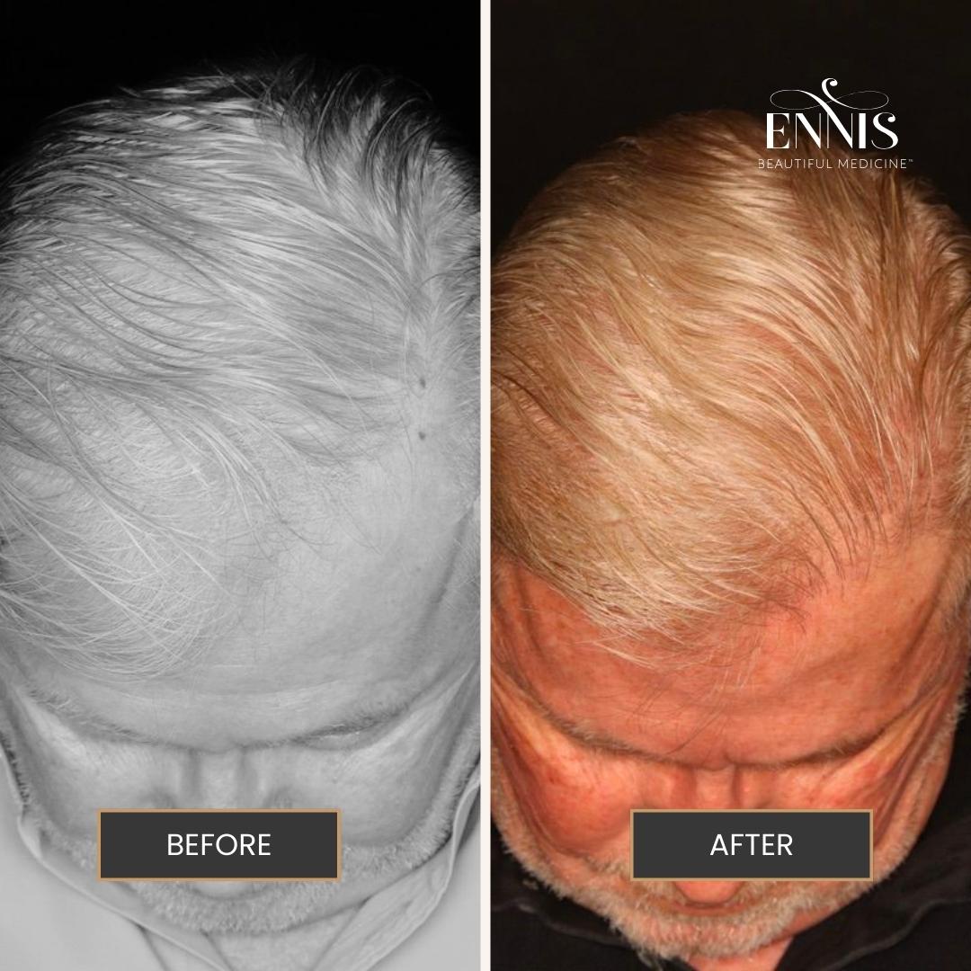 Hair Transplant / Restoration Before & After Photos | Ennis Plastic Surgery