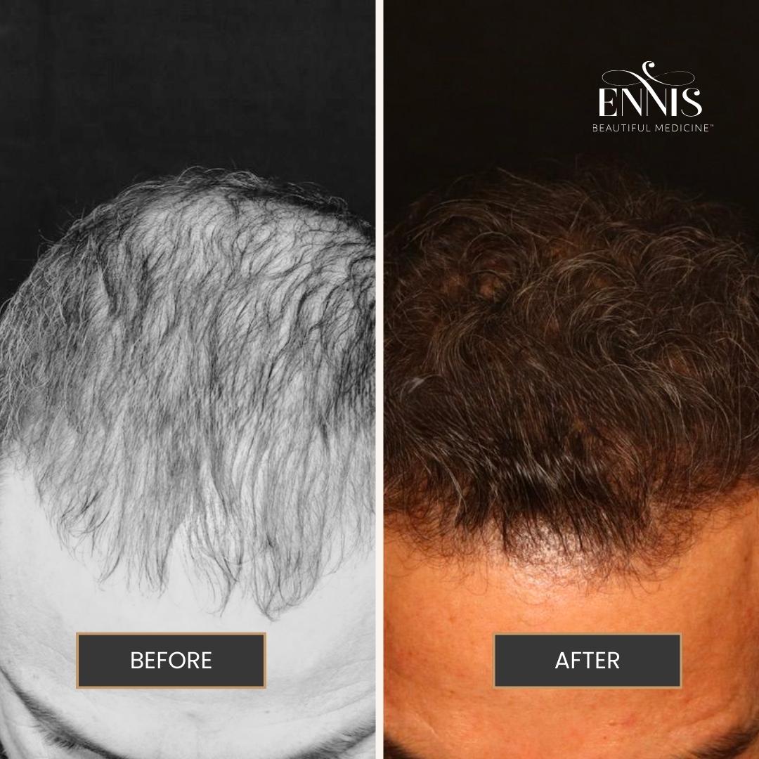 Hair Transplant / Restoration Before & After Photos | Ennis Plastic Surgery