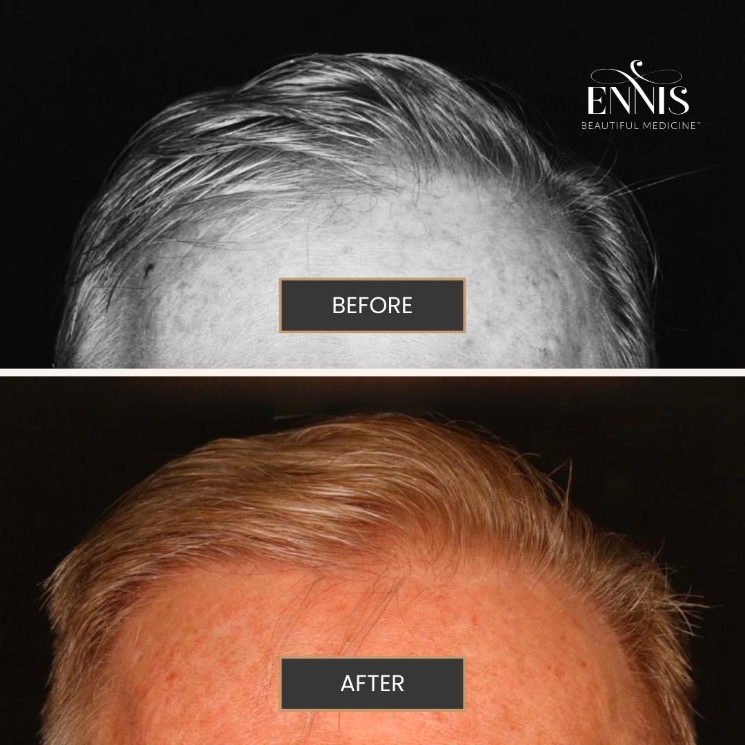 Hair Transplant / Restoration Before & After Photos | Ennis Plastic Surgery