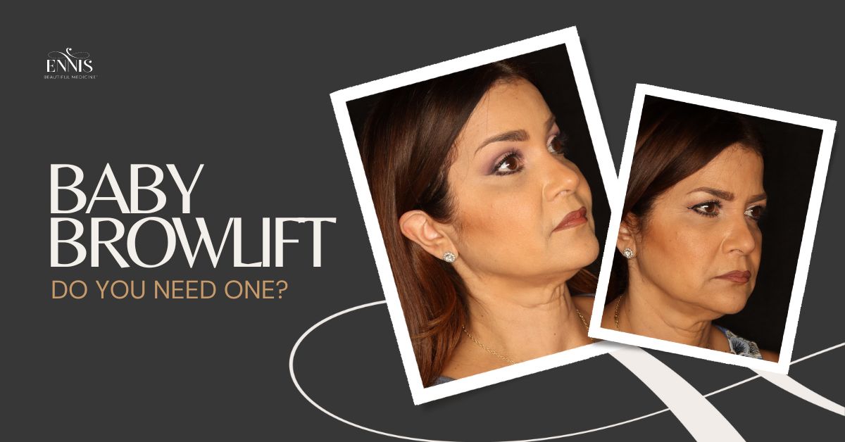 Baby Brow Lift in Florida with Top Rated Plastic Surgeon Dr. Ennis